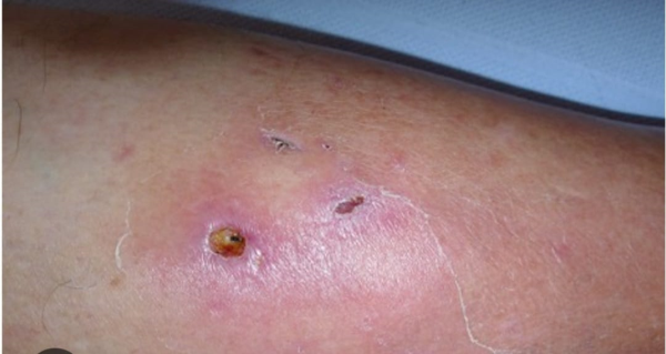 Melioidosis: A Disease That is Overlooked